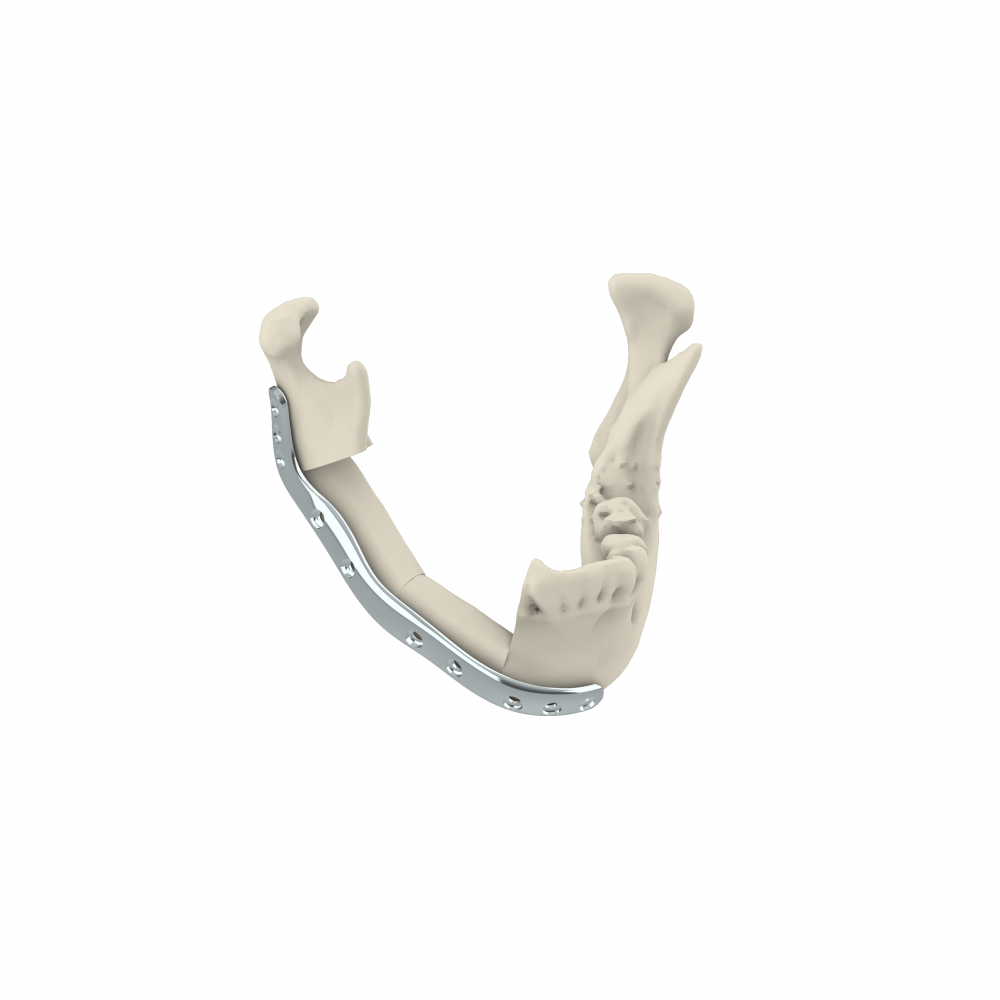 METICULY: Patient-specific Mandibular Plate for Mandibular ...